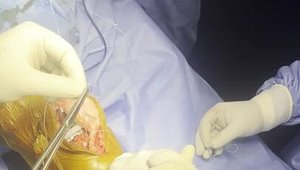 Reattachment of Patellar Tendon After Avulsion During Lateral ...