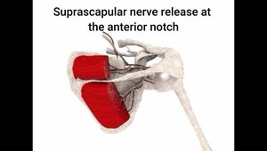 Suprascapular Nerve Release in a Patient with Bifocal Compression | VuMedi