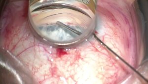 Elios Excimer Laser Trabeculostomy (ELT) Procedure - Microinvasive ...