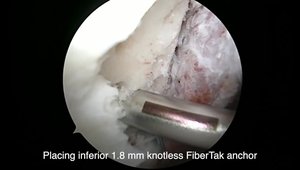 Posterior Bony Bankart Bridge for the Treatment of Bony Bankart Lesions ...