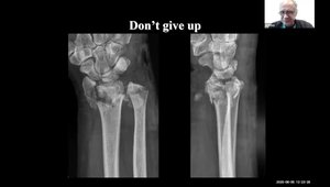 Volar Plating of DRF's: How Do I Stay Out of Trouble? | Vumedi