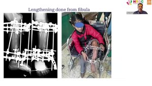 Gap Non-Union of Tibia Treated With Huntington Procedure and External ...