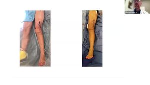 Deformity Correction With Exramedullary & IM Lengthening Nail | Vumedi