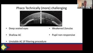 WGC 2025 Insights: Cataract Surgery in Hypotonous Eyes | Vumedi
