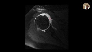 Introduction to Musculoskeletal Shoulder MRI | Vumedi