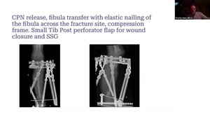 Post-Traumatic Infected Tibia Fracture With Bone Loss: Fibular Transfer ...