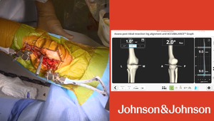 Partial Knee Arthroplasty with VELYS UKA & SIGMA™ HP Uni - Retrialing ...