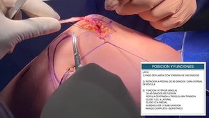 Reconstruccion Del Ligamento Patelofemoral Medial + MQTFL Con ...