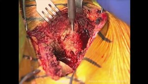 Sternoclavicular Joint Reconstruction in 2025 | Vumedi