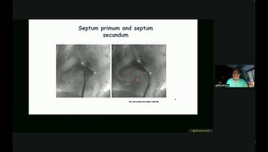 Device Selection- A PFO Anatomy Based Approach: Case Studies | VuMedi