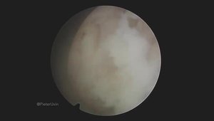 Redo MiLEP After Prior TURP Procedure | Vumedi