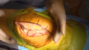 Partial Knee Arthroplasty with VELYS UKA & SIGMA™ HP Uni - Array ...