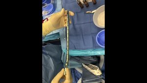 Statically Locked Tibial Antibiotic Coated Nail | Vumedi