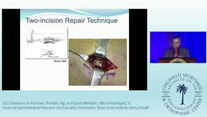 Distal Biceps Tendon Injuries - 2025 Update | Vumedi
