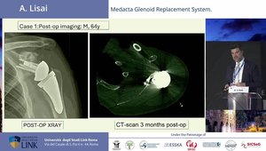 Navigation in Shoulder Arthroplasty: Accuracy in Glenoid Baseplate ...