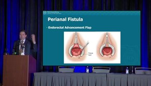 Surgical IBD Management: Perianal Fistula/Setons and Intestinal ...