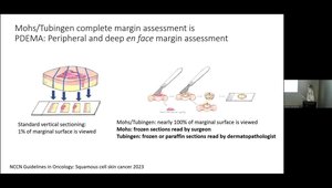 Managing High-Risk Squamous Cell Carcinoma (SCC) and Its Precursors ...