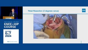 Caliper Based Kinematic Alignment: No Robot Required | Vumedi