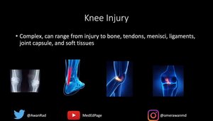Musculoskeletal MSK Radiology Case: Knee Ligament Injury | Vumedi
