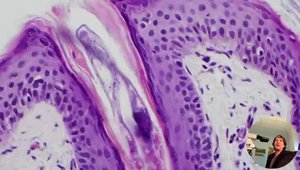 Blackhead Under the Microscope! (Open Comedones, Demodex Mites ...