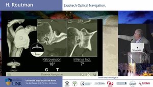 Reverse Shoulder Arthroplasty With Navigation: Accuracy, Efficiency ...