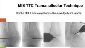 Deformity Correction in Acute & Chronic Settings With Minimally ...
