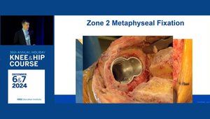 Zonal Fixation in Revision TKA | Vumedi