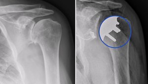Superior outcomes in stemless shoulder arthroplasty: Inside the Most ...