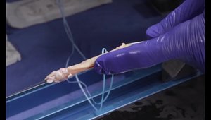 Quad Tendon ACLR Using the Mitek Sports Medicine Suspensory Fixation ...