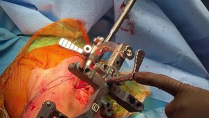 Short Humeral Intramedullary Nail Technique video | Vumedi