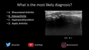 Musculoskeletal MSK Radiology Case: Osteoarthritis at the AC Joint | Vumedi