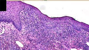 Langerhans Cell Histiocytosis of Skin (LCH) Pathology Histology ...