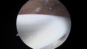 Endoscopic Pectoralis Minor Release for Neurogenic Thoracic Outlet ...