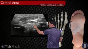 Plantar Fascia and Sole of Foot: Ultrasound Anatomy Using the “Pac-Man ...
