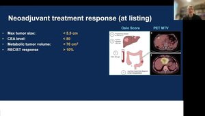 ASCO® GI 2026 Summary: Liver Transplantation in Unresectable CRC Liver ...