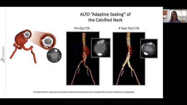 Clinical Case Review: Complex Infrarenal AAA EVAR in a Calcified ...
