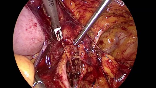 Laparoscopic Ureteric Dissection for Adhesions During Type B Radical ...