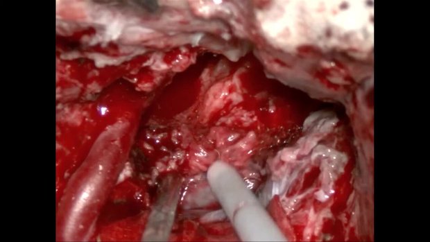 University of Utah Neurosurgery | Vumedi