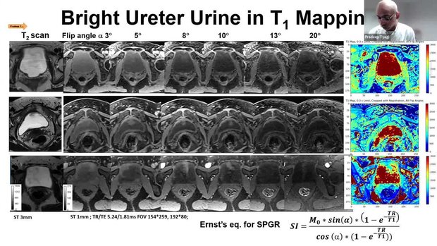 AUA2026 Insights: Magnetic Resonance Fingerprinting Reveals Water ...